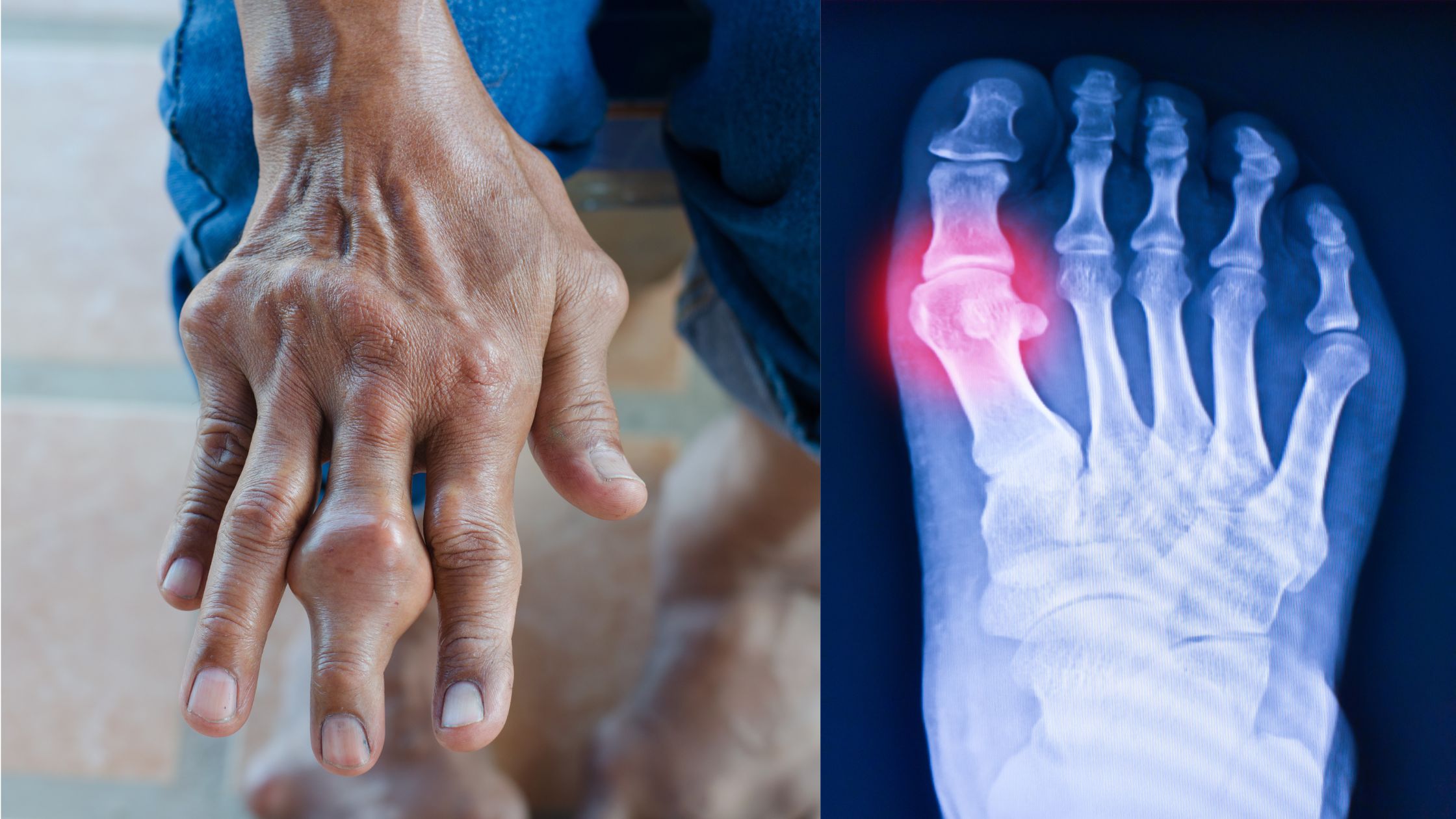 Guta: cauze, simptome, regim alimentar și tratament natural ...